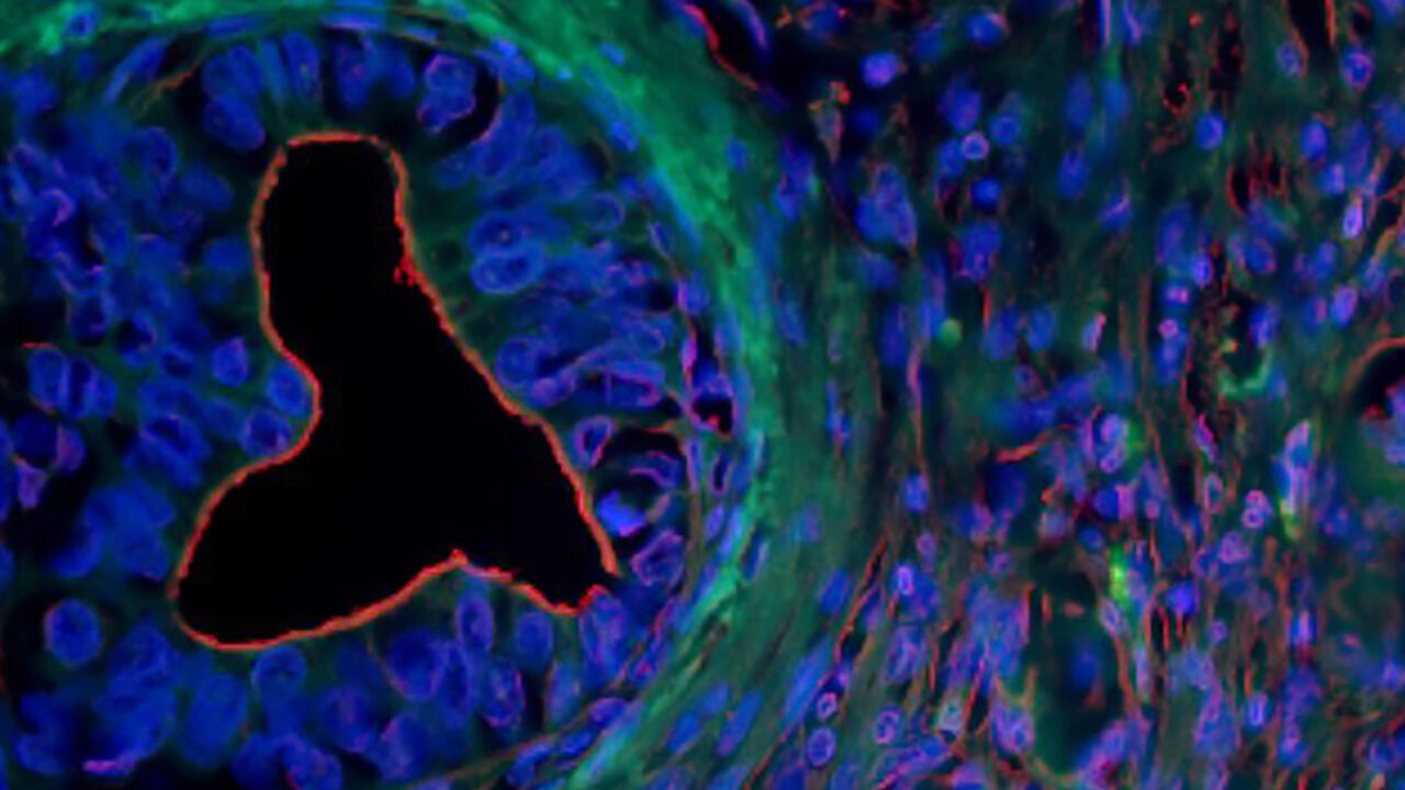 SRI researchers identify a biomarker to target and treat pancreatic ...